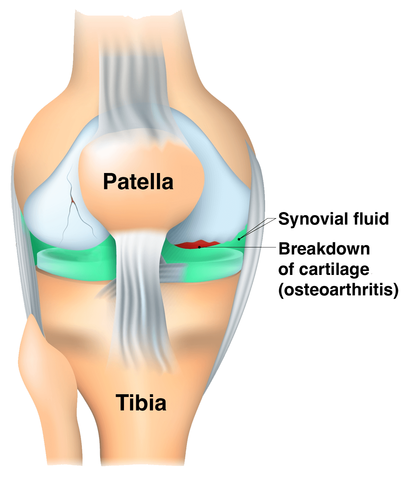 Knee Pain Treatment | Non-Surgical Relief with Gel Injections | Joint ...