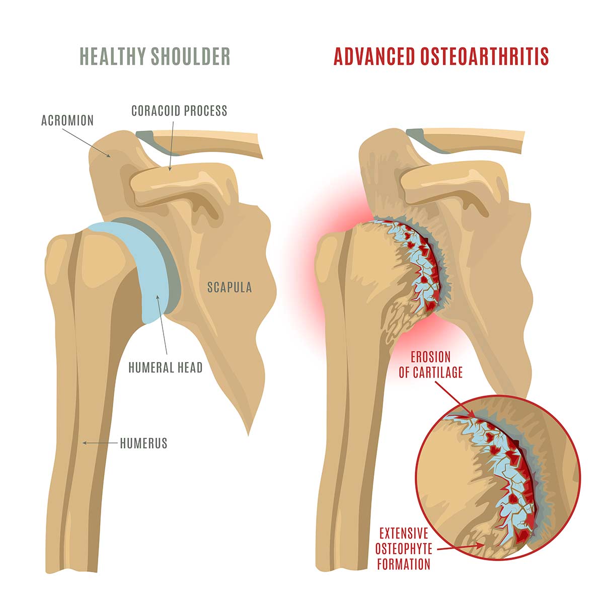 Shoulder Pain Treatment | Non-Surgical Relief with Gel Injections ...